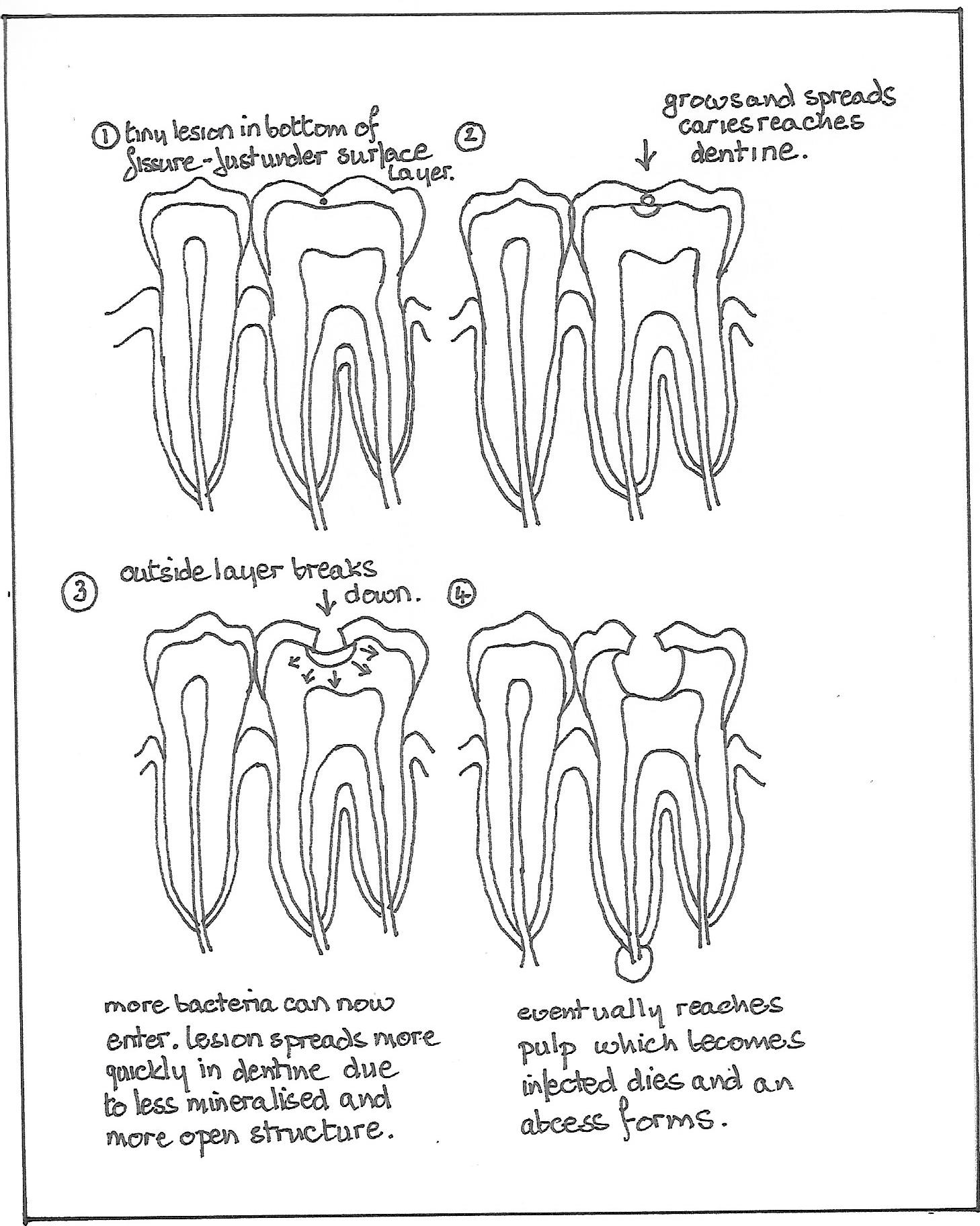 Chapter 1- Tooth Decay [Caries] – How To Look After Your Teeth