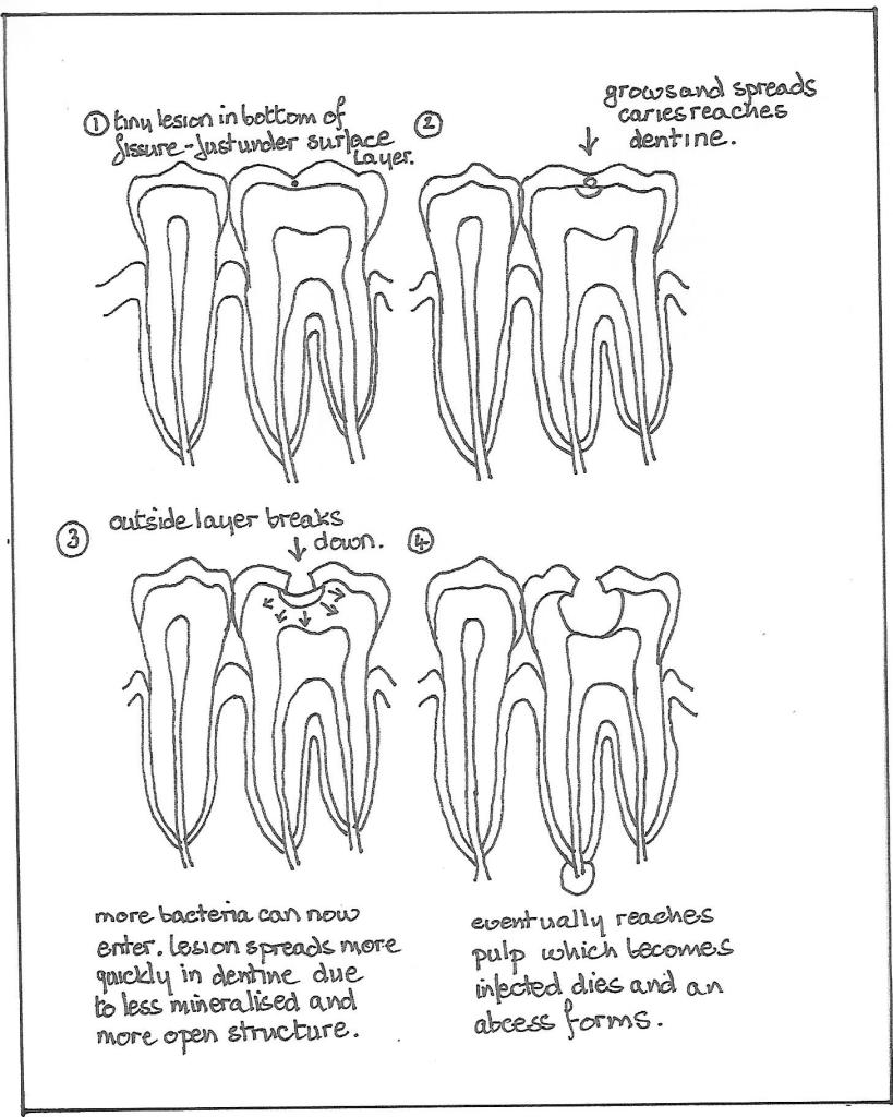 Chapter 1- Tooth Decay [Caries] – How To Look After Your Teeth